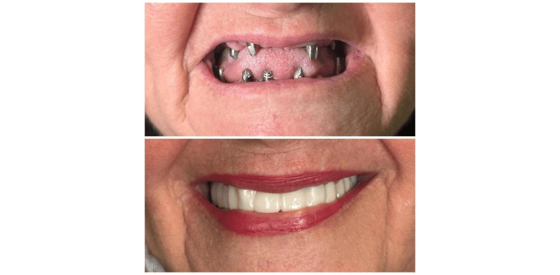 Dental-Implants-Testimonials – Orthosquare Multispecialty Dental Chain